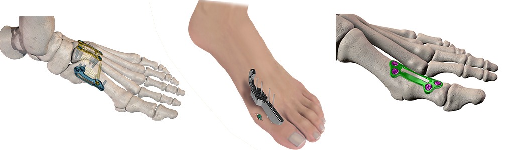 Greater Chicago Area Foot and Ankle Symposium - CrossRoads Extremity